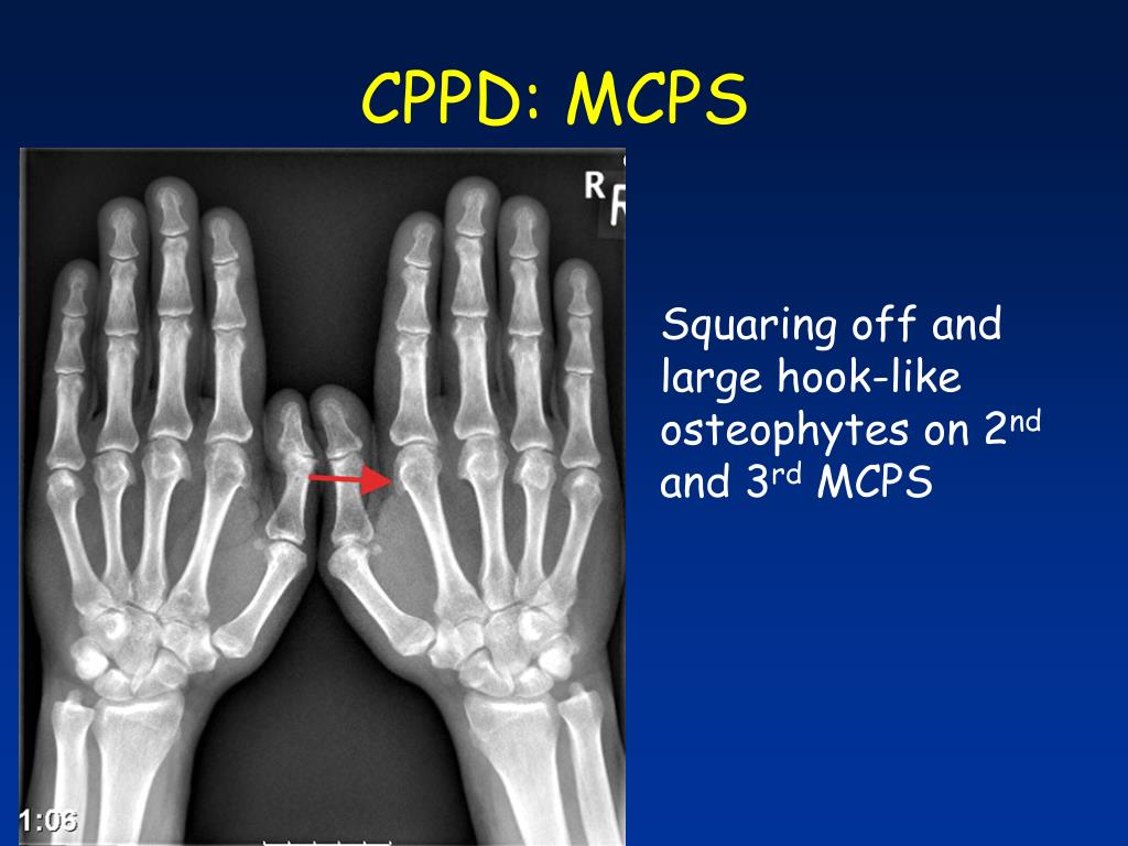 PPT - Crystal-induced arthritis & Osteoarthritis PowerPoint ...