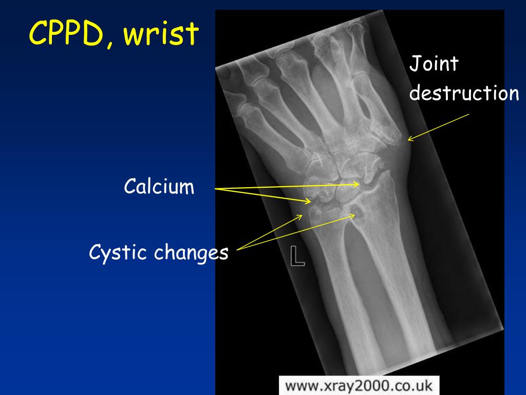 PPT - Crystal-induced arthritis & Osteoarthritis PowerPoint ...