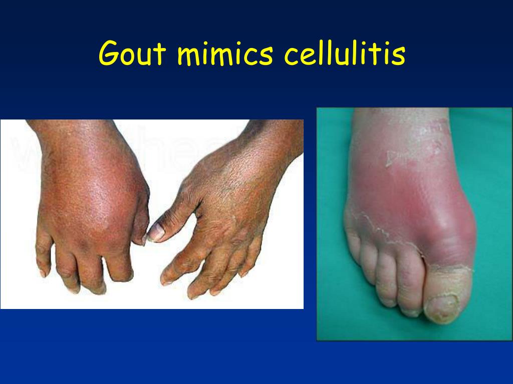 PPT - Crystal-induced arthritis & Osteoarthritis PowerPoint ...