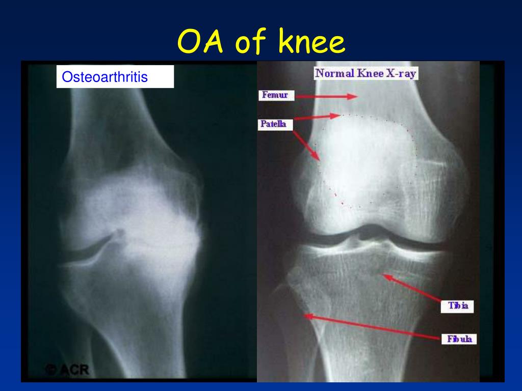 PPT - Crystal-induced arthritis & Osteoarthritis PowerPoint ...