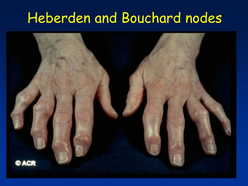 PPT - Crystal-induced arthritis & Osteoarthritis PowerPoint ...