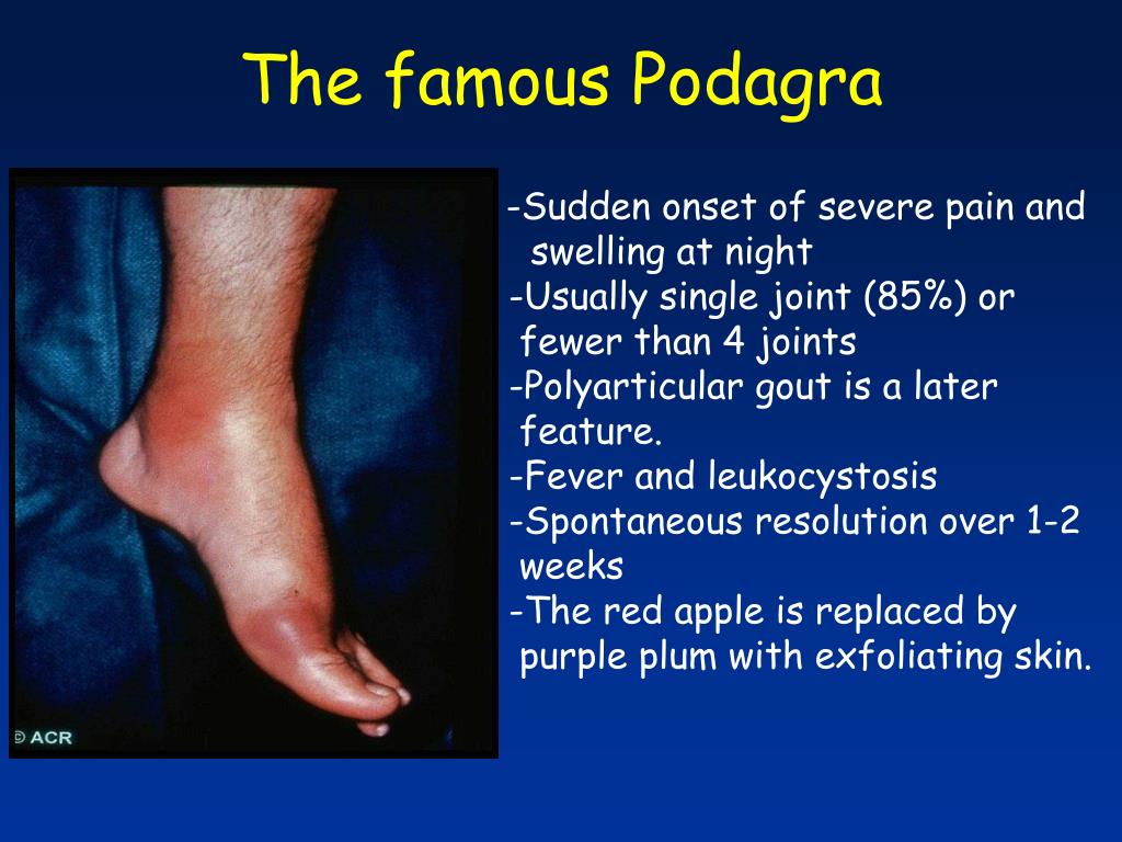 PPT - Crystal-induced arthritis & Osteoarthritis PowerPoint ...
