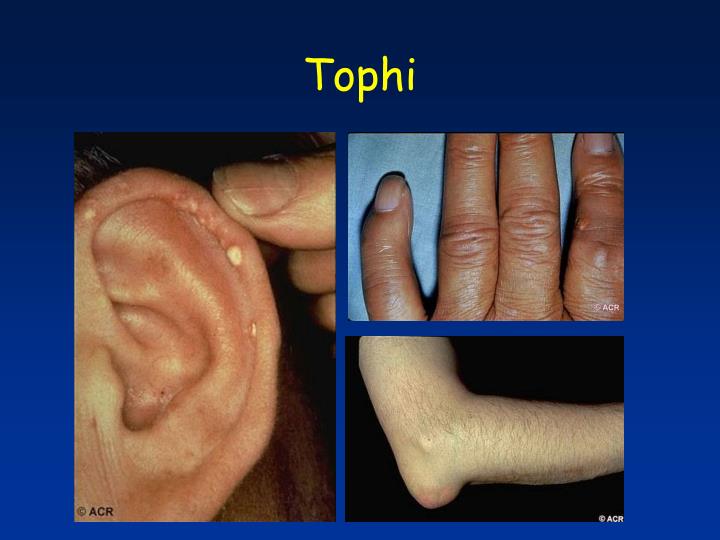 PPT - Crystal-induced arthritis & Osteoarthritis PowerPoint ...