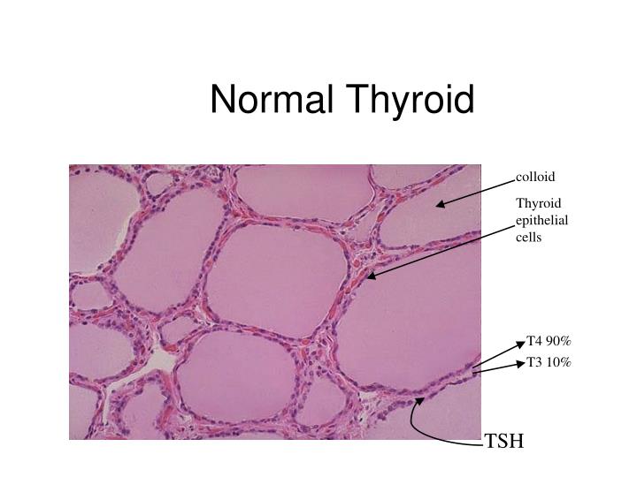 PPT - Goiter PowerPoint Presentation - ID:2913506