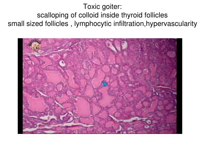 PPT - Goiter PowerPoint Presentation - ID:2913506