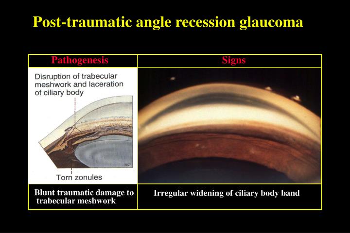 PPT - SECONDARY GLAUCOMAS PowerPoint Presentation - ID:2914282