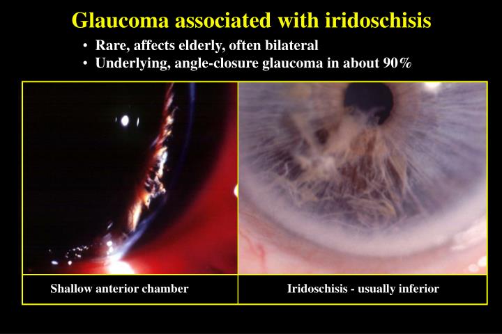 PPT - SECONDARY GLAUCOMAS PowerPoint Presentation - ID:2914282