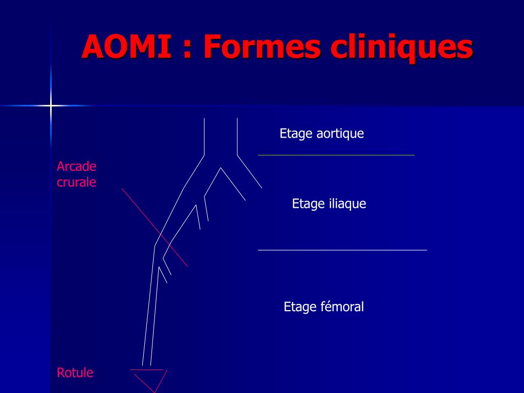 PPT - Artériopathie oblitérante des membres inférieurs (AOMI ...