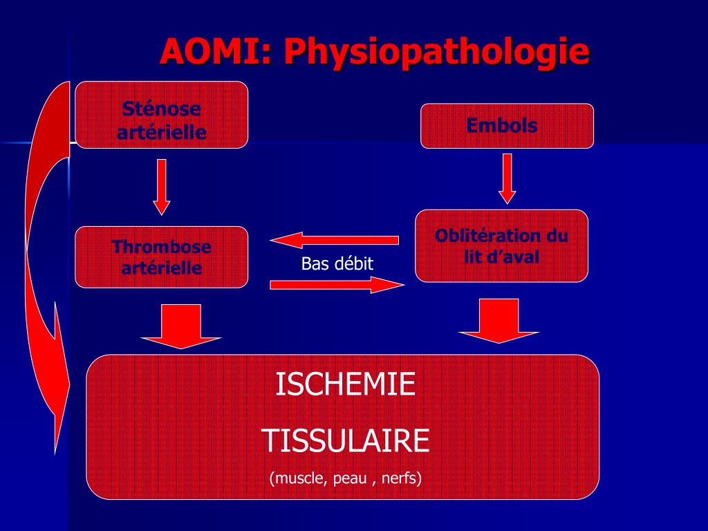 PPT - Artériopathie oblitérante des membres inférieurs (AOMI ...