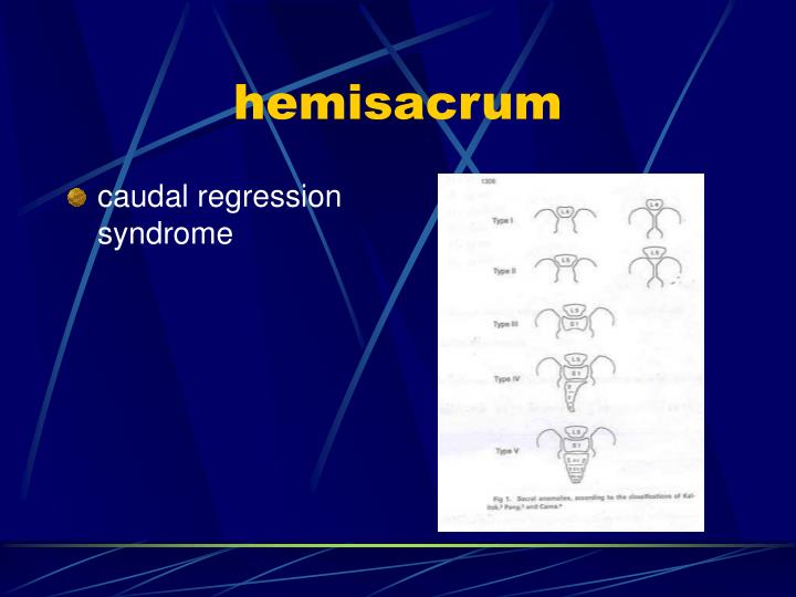 PPT - Currarino Syndrome- Case Report PowerPoint Presentation - ID:2914369