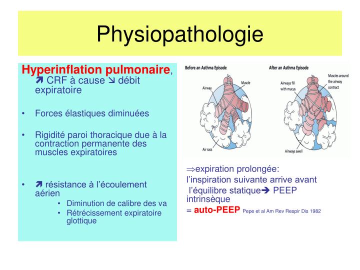 PPT - La ventilation mécanique dans l’asthme aigu grave: aspects ...