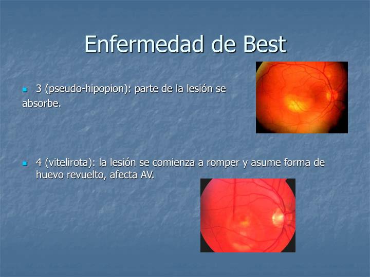 PPT - Distrofias Maculares PowerPoint Presentation - ID:2918634