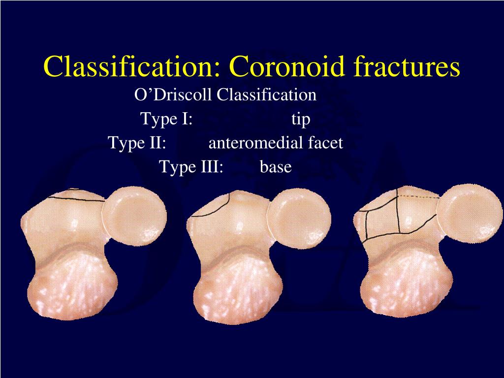 PPT - Surgical Approaches for “ Terrible Triad ” Fracture-Dislocations ...
