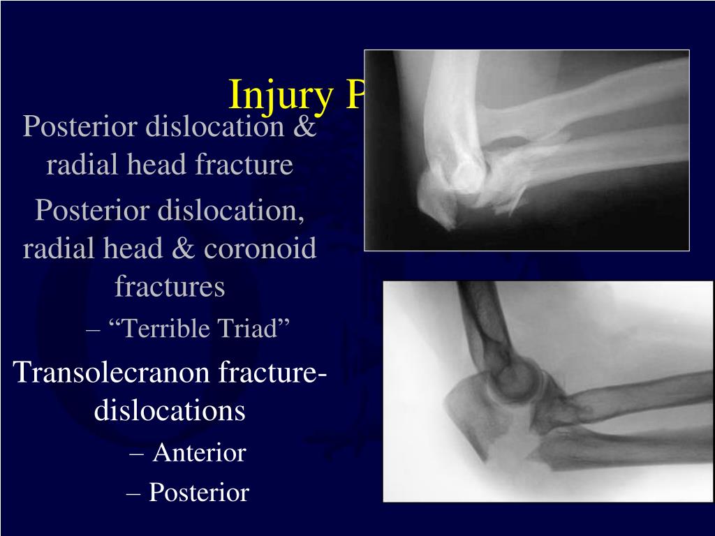 PPT - Surgical Approaches for “ Terrible Triad ” Fracture-Dislocations ...