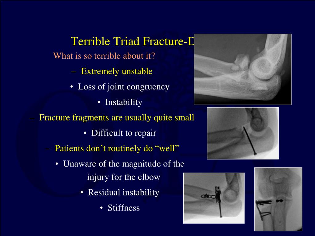PPT - Surgical Approaches for “ Terrible Triad ” Fracture-Dislocations ...