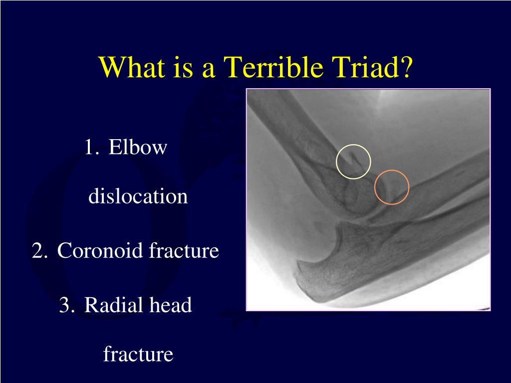 PPT - Surgical Approaches for “ Terrible Triad ” Fracture-Dislocations ...