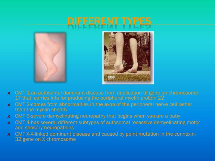 PPT - Charcot-Marie-Tooth Disease PowerPoint Presentation - ID:2921462