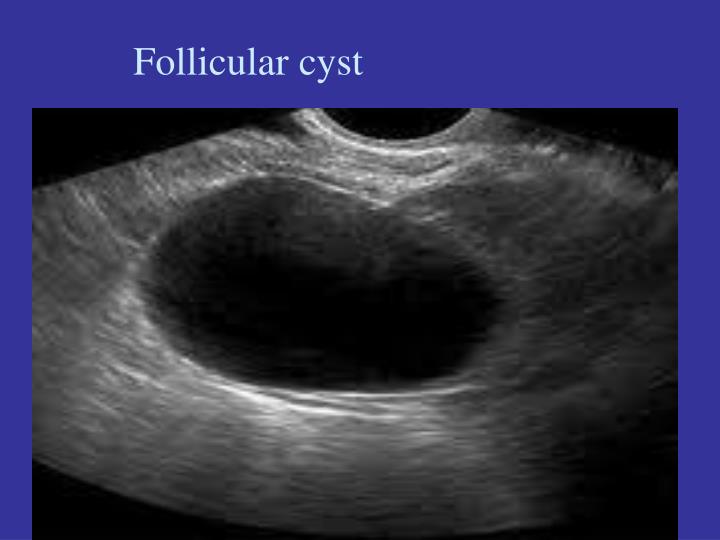 PPT - Ovarian cysts PowerPoint Presentation - ID:2925045