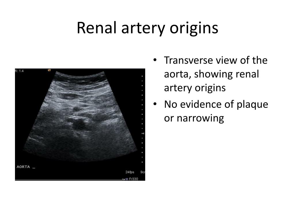 PPT - Renal artery Ultrasound study PowerPoint Presentation, free ...
