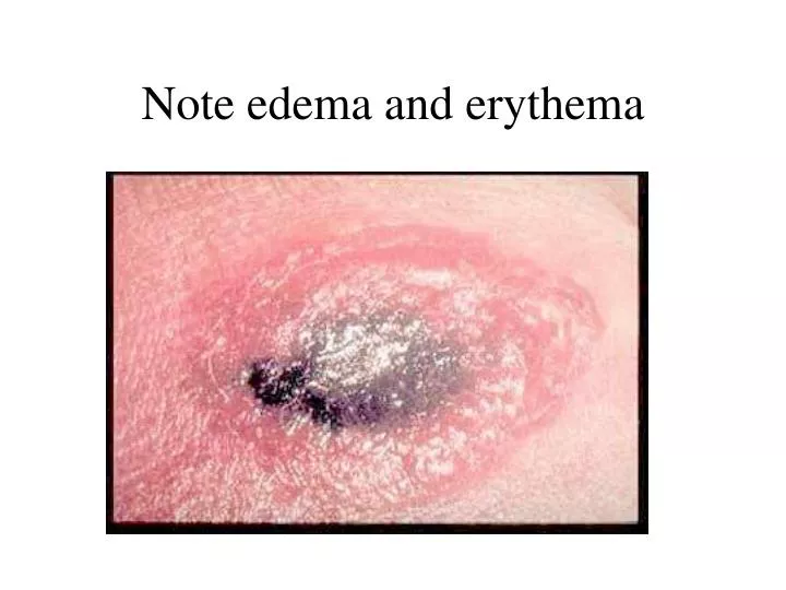 PPT - Note edema and erythema PowerPoint Presentation, free download ...