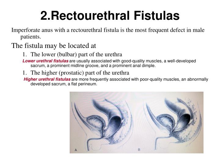 PPT - Anorectal Malformation Imperforate anus PowerPoint Presentation ...