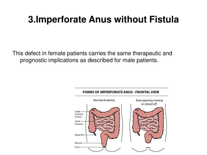 PPT - Anorectal Malformation Imperforate anus PowerPoint Presentation ...