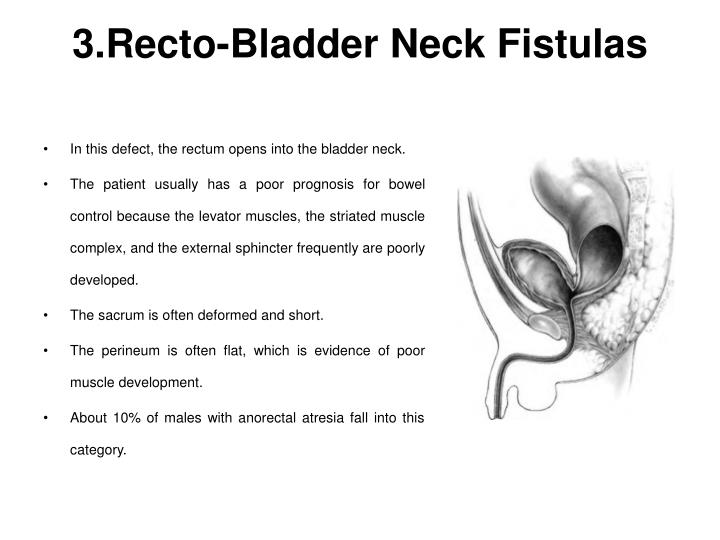 PPT - Anorectal Malformation Imperforate anus PowerPoint Presentation ...