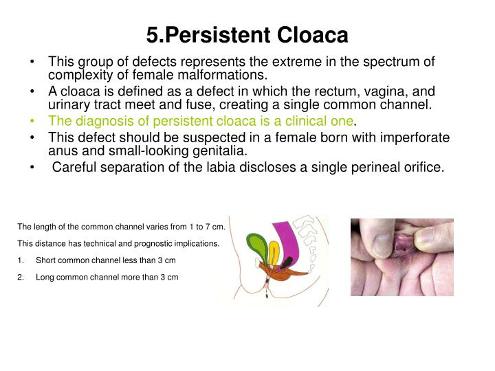 PPT - Anorectal Malformation Imperforate anus PowerPoint Presentation ...