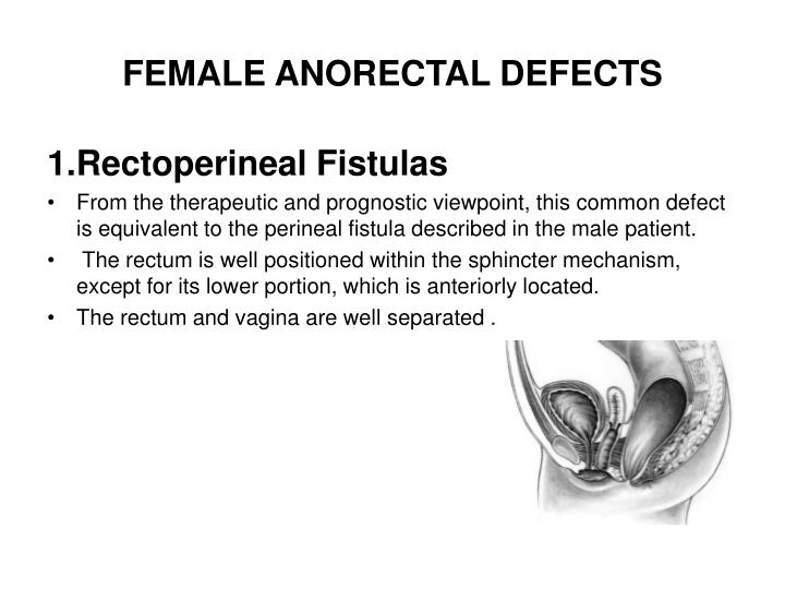 PPT - Anorectal Malformation Imperforate anus PowerPoint Presentation ...