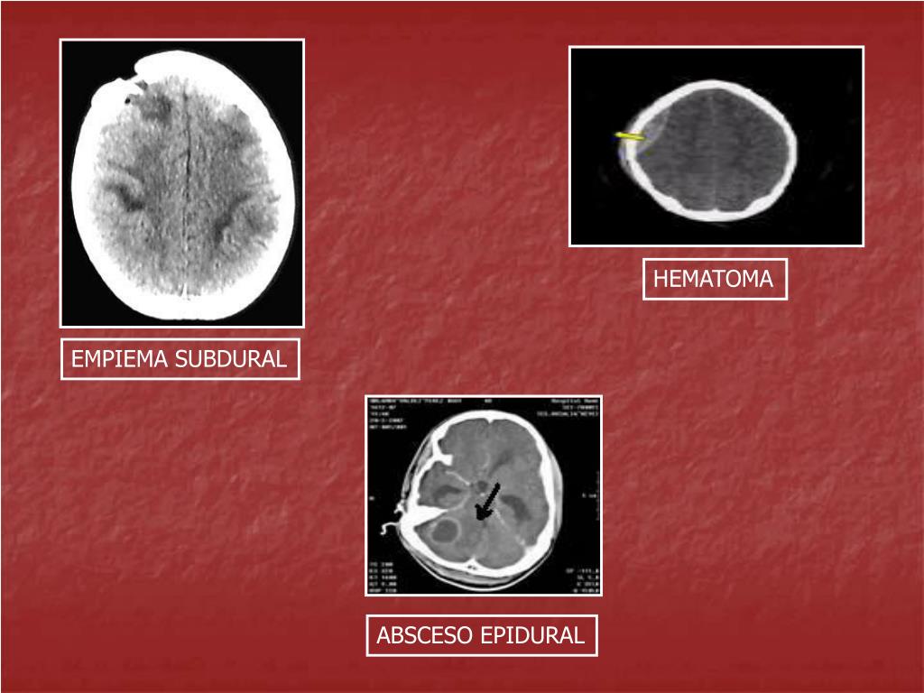 PPT - ABSCESO CEREBRAL DE ETIOLOGIA INFRECUENTE PowerPoint Presentation ...