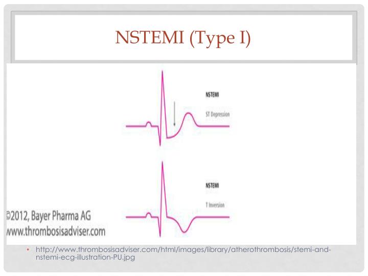 PPT - Acute Coronary Syndrome Update PowerPoint Presentation - ID:2939512