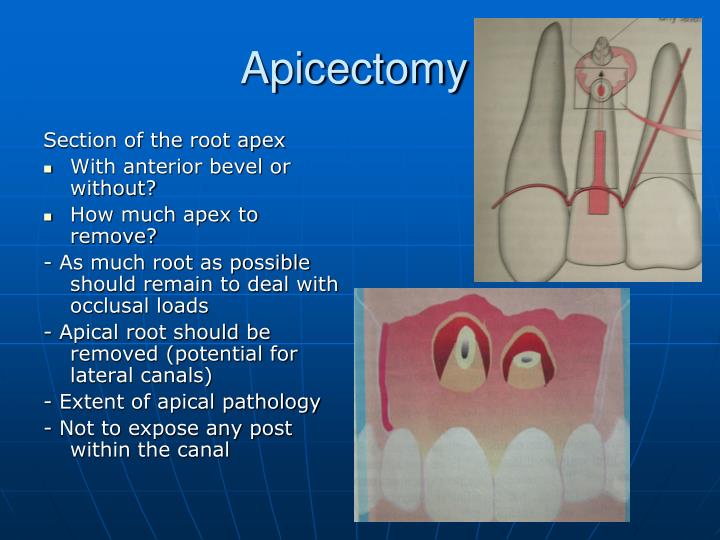 PPT - Acute Alveolar Osteitis PowerPoint Presentation - ID:2940458
