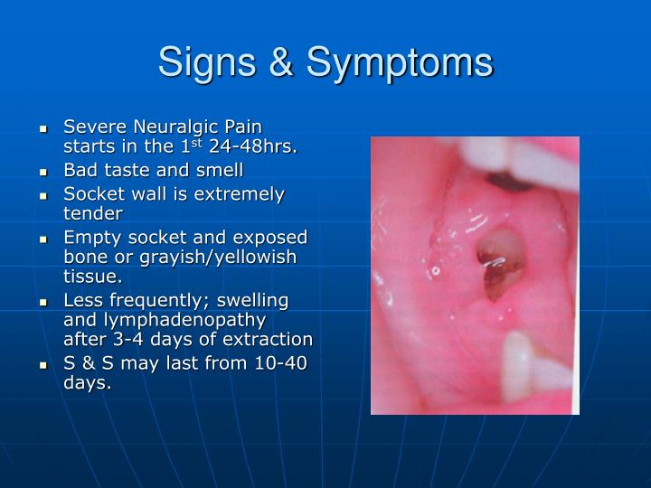 PPT - Acute Alveolar Osteitis PowerPoint Presentation - ID:2940458