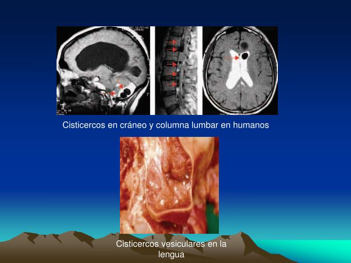 PPT - CISTICERCOSIS PowerPoint Presentation - ID:2941048