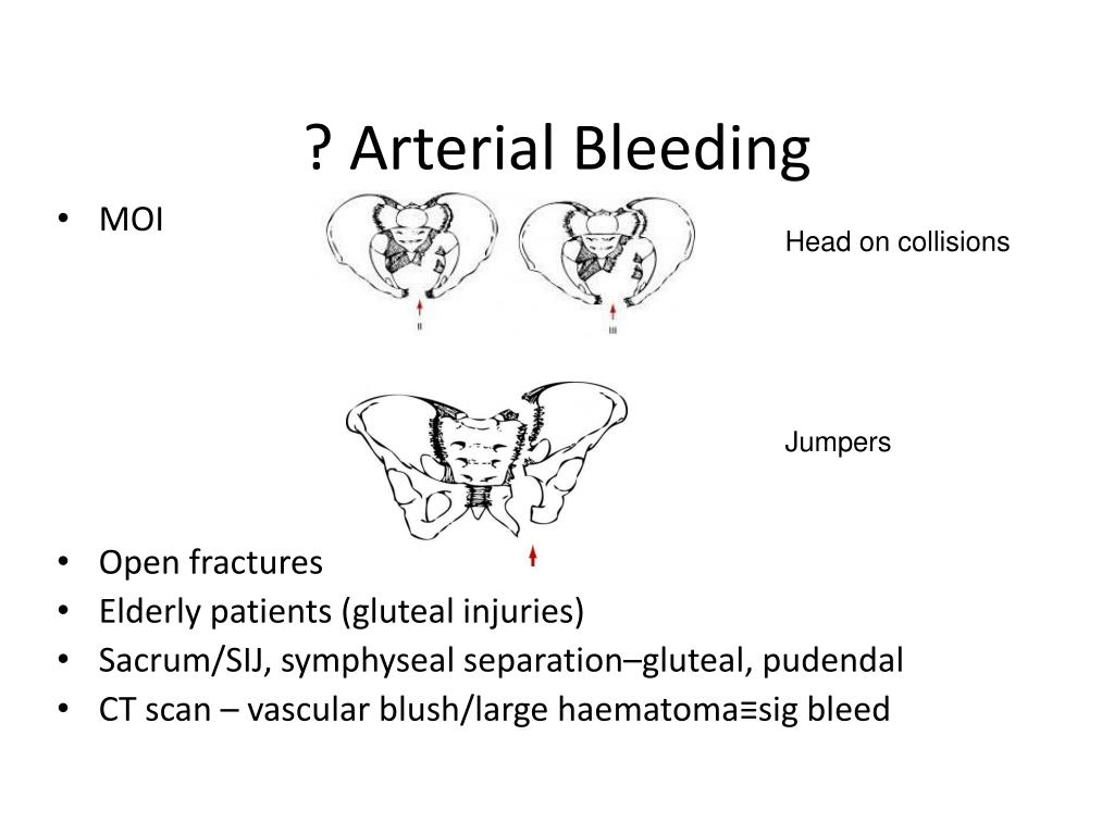 PPT - Pelvic Fractures 2 nd Northern Trauma Network Conference ...