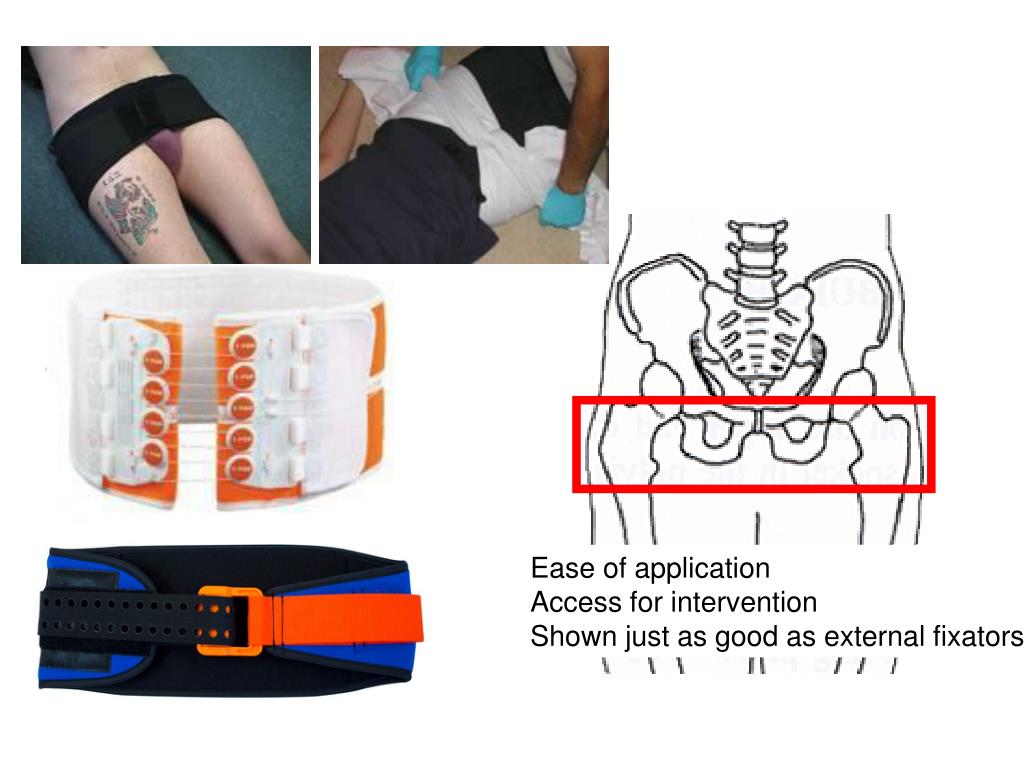 PPT - Pelvic Fractures 2 nd Northern Trauma Network Conference ...