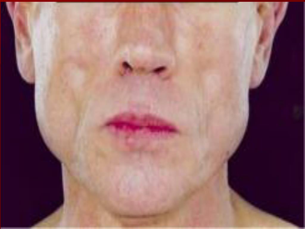 PPT - Chiropractic Management of the HIV/AIDS Patient PowerPoint ...