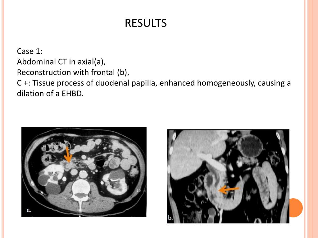 PPT - IMAGING AMPULLOMA OF VATER’S PAPILLE SERIES OF FIFTEEN CASES ...