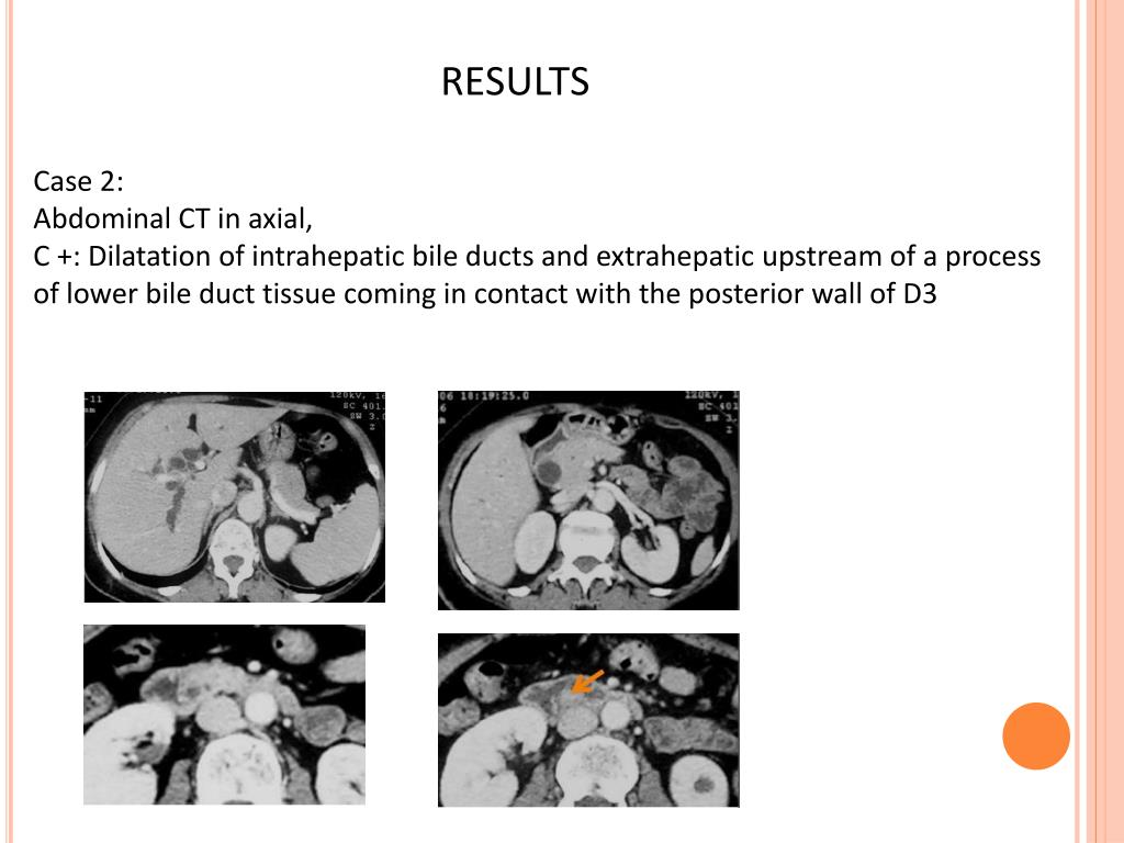 PPT - IMAGING AMPULLOMA OF VATER’S PAPILLE SERIES OF FIFTEEN CASES ...