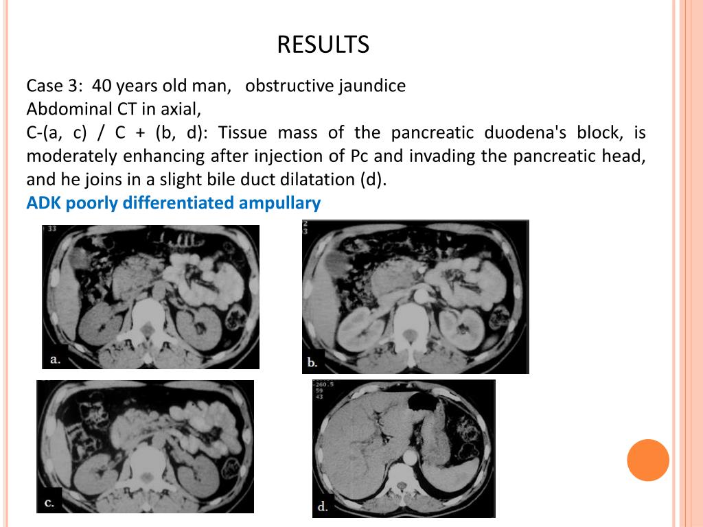 PPT - IMAGING AMPULLOMA OF VATER’S PAPILLE SERIES OF FIFTEEN CASES ...