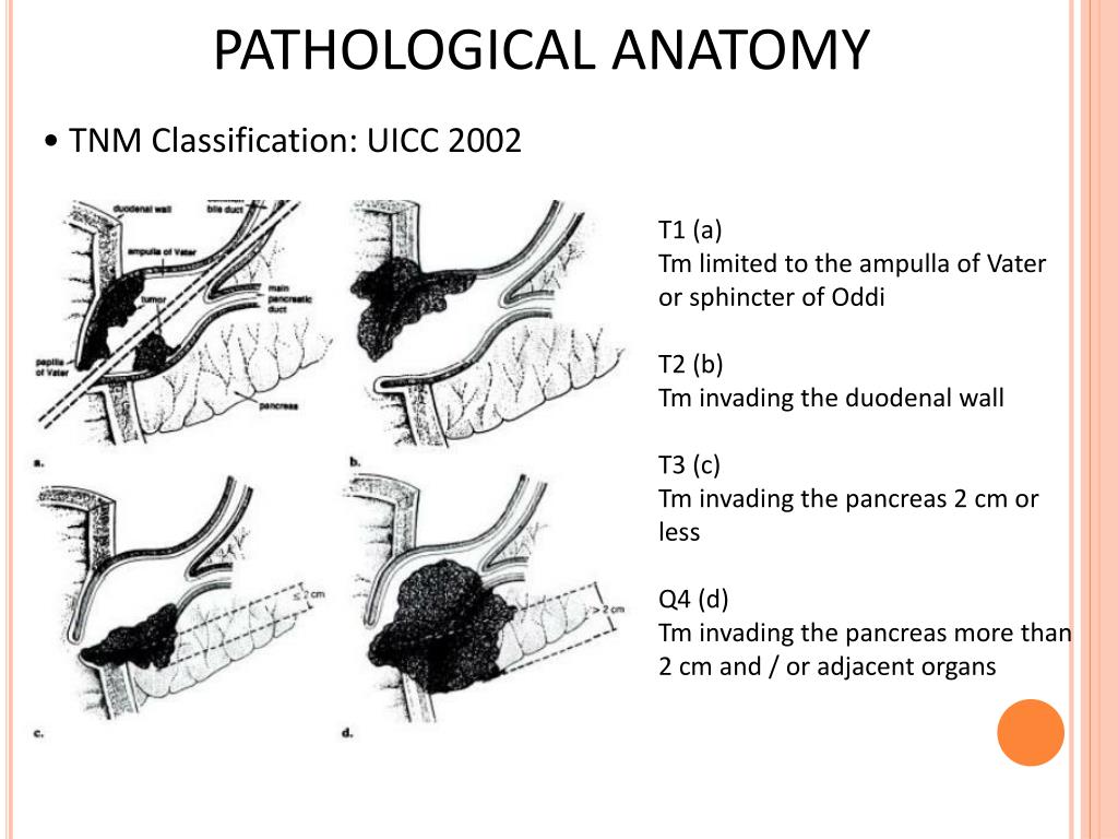 PPT - IMAGING AMPULLOMA OF VATER’S PAPILLE SERIES OF FIFTEEN CASES ...