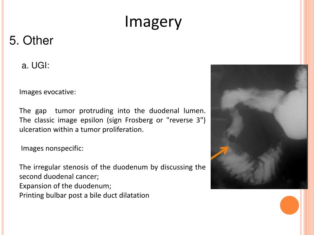PPT - IMAGING AMPULLOMA OF VATER’S PAPILLE SERIES OF FIFTEEN CASES ...
