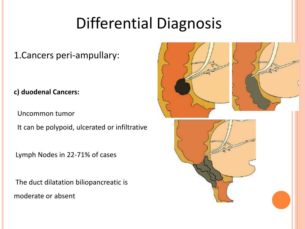 PPT - IMAGING AMPULLOMA OF VATER’S PAPILLE SERIES OF FIFTEEN CASES ...