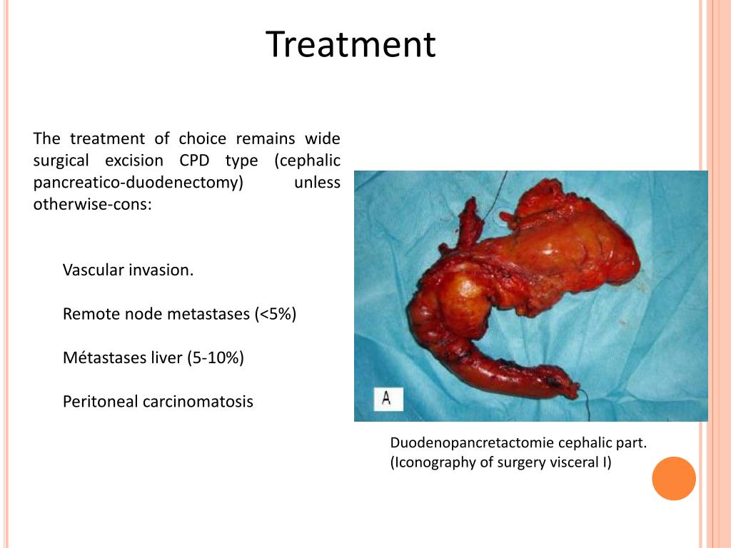 PPT - IMAGING AMPULLOMA OF VATER’S PAPILLE SERIES OF FIFTEEN CASES ...