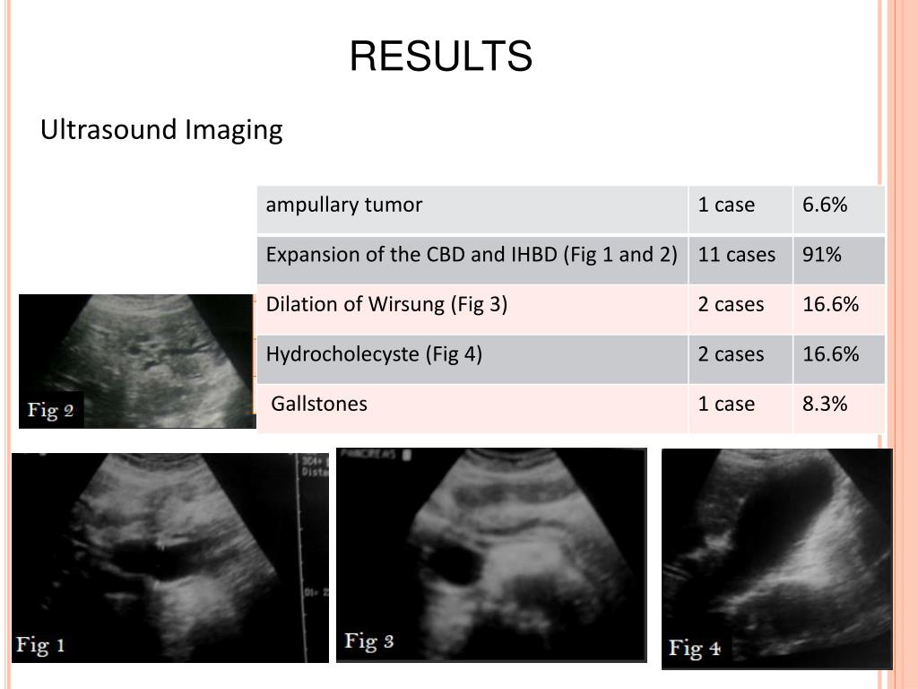 PPT - IMAGING AMPULLOMA OF VATER’S PAPILLE SERIES OF FIFTEEN CASES ...
