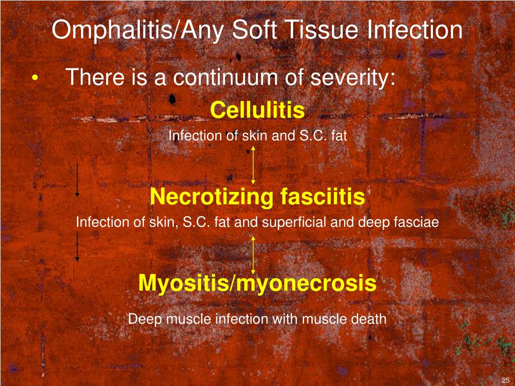 PPT - Acute Umbilical Complaints in the Pediatric ER PowerPoint ...