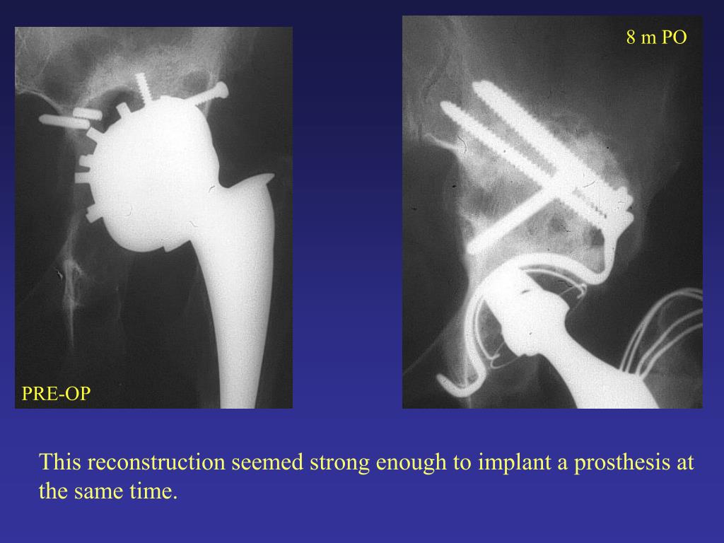 PPT - ACETABULAR RECONSTRUCTION WITH ALLOGRAFTS, METALLIC ARMATURE AND ...