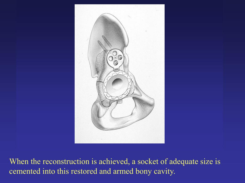 PPT - ACETABULAR RECONSTRUCTION WITH ALLOGRAFTS, METALLIC ARMATURE AND ...