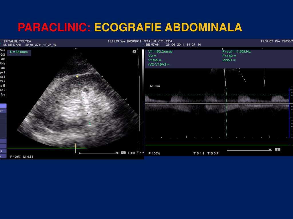 PPT - HIPERTENSIUNE ARTERIALA, DIABET SI EDEME PREZENTARE DE CAZ ...