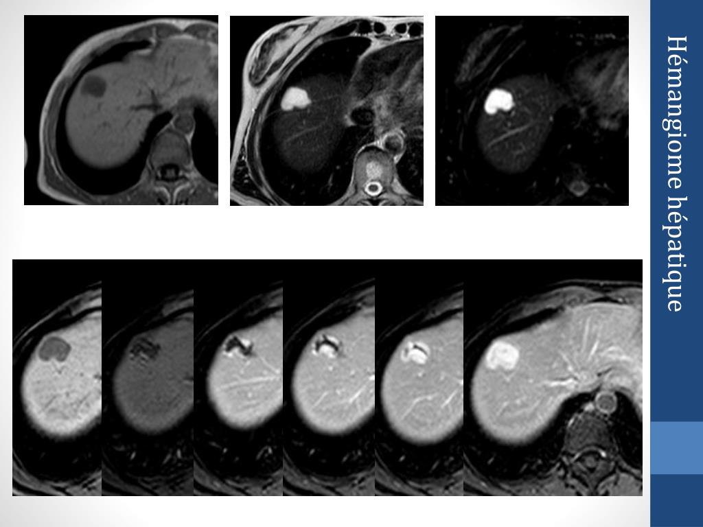 PPT - Imagerie des tu meurs bénignes du foie PowerPoint Presentation ...